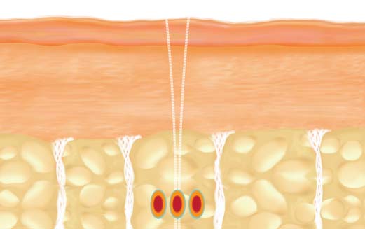 FOCUSDUAL - HIFU Skin Tightening Machine - CliniMed Aesthetics